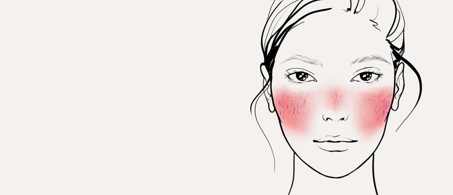 Guide pour la peau sujette à la couperose et à la rosacée | Dr ...